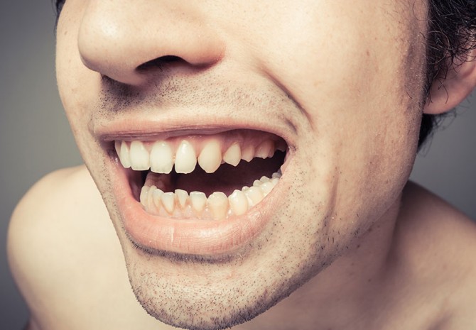 Tooth Discolouration | Misaligned Teeth | Pinewood Dental | Pinewood ...